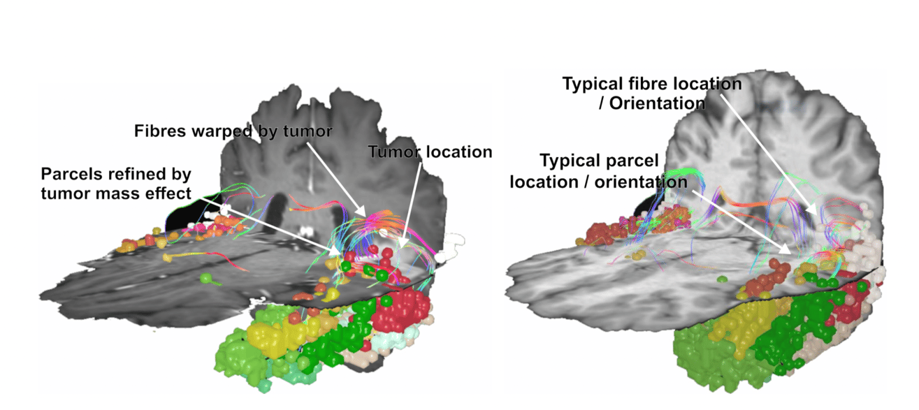 Structural Connectivity Atlas: How to build personalized brain maps?